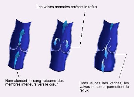 Varices à Lyon | Centre de Médecine Vasculaire Ouest Lyonnais